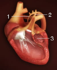 Hypoplastic Left Heart Syndrome | Image Summary | Cincinnati Children's ...
