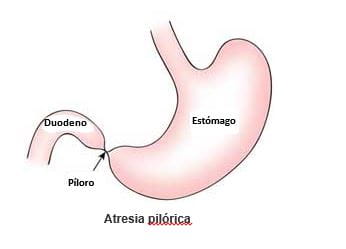 Atresia y estenosis intestinal | Tipos, diagnóstico y tratamiento
