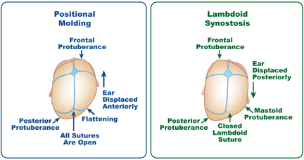 Craniosynostosis | Symptoms, Diagnosis & Treatment