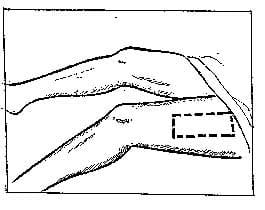 Intramuscular Injection (IM)