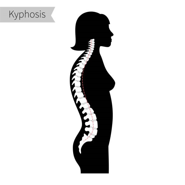 Kyphosis | Causes, Symptoms & Treatment