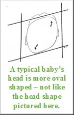 Plagiocephaly