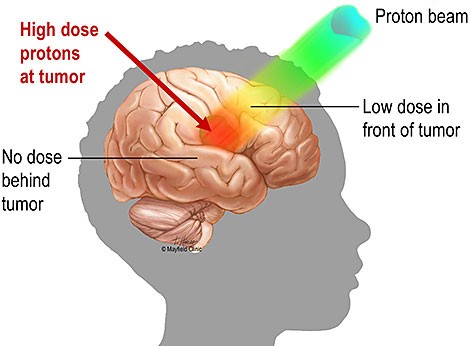 Proton Therapy Treatment