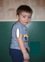 Subcutaneous (Sub-Q) Injections