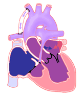 Single Ventricle Heart Defect | Symptoms, Diagnosis & Repair