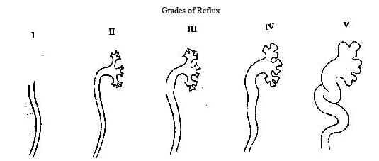Vesicoureteral Reflux (VUR)