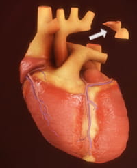 Coarctation of the Aorta | Image Summary