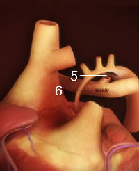 Hypoplastic Left Heart Syndrome | Image Summary