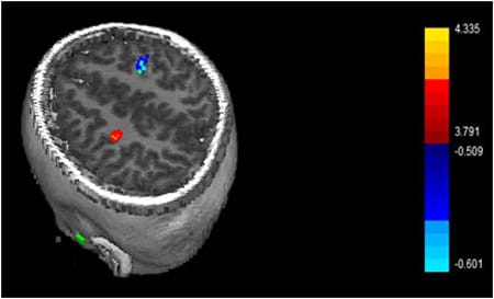 MEG Study of Cerebral Palsy | Xiang Lab