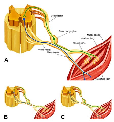 Afferent innervation, muscle spindles & neuromuscular contractures ...