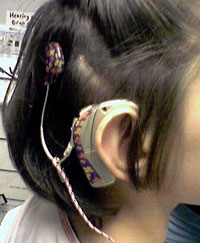 Cochlear Implant Program | Cincinnati Children's