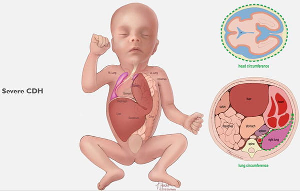 Congenital Diaphragmatic Hernia (CDH) | Fetal Diagnosis & Repair ...