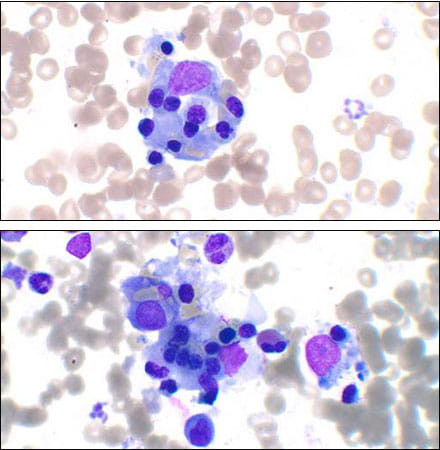 Increasing Awareness of HLH | HLH Center of Excellence