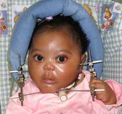 Neonatal Jaw (Mandibular) Distraction | Treatments & Procedures