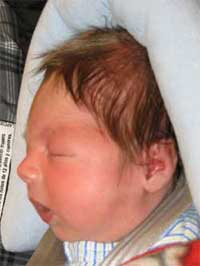 Neonatal Jaw (Mandibular) Distraction | Treatments & Procedures